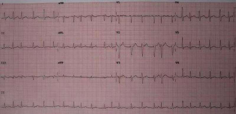 Virtual ward for atrial fibrillation patients could prevent thousands ...