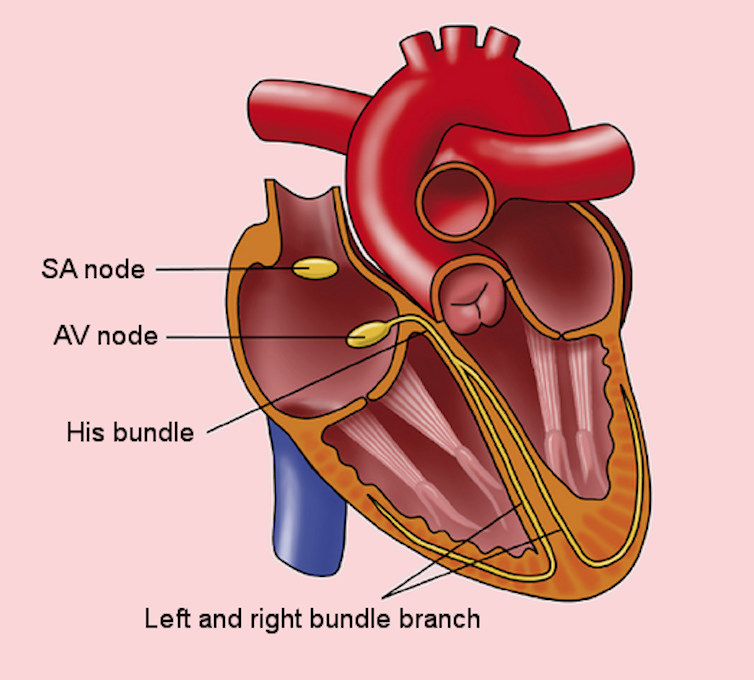 How do pacemakers and defibrillators work? A cardiologist explains how they interact with the ...
