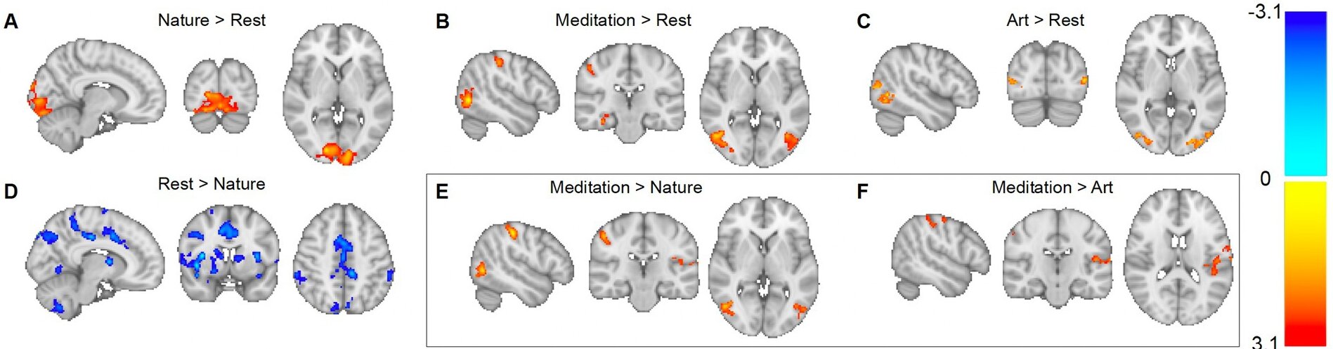 Neuroimaging reveals distinct patterns of brain activation - Ideas and ...